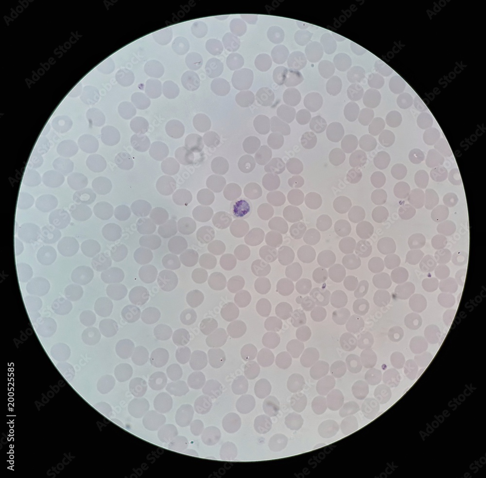 Human parasite on thin film of blood smear with Plasmodium ovale ...