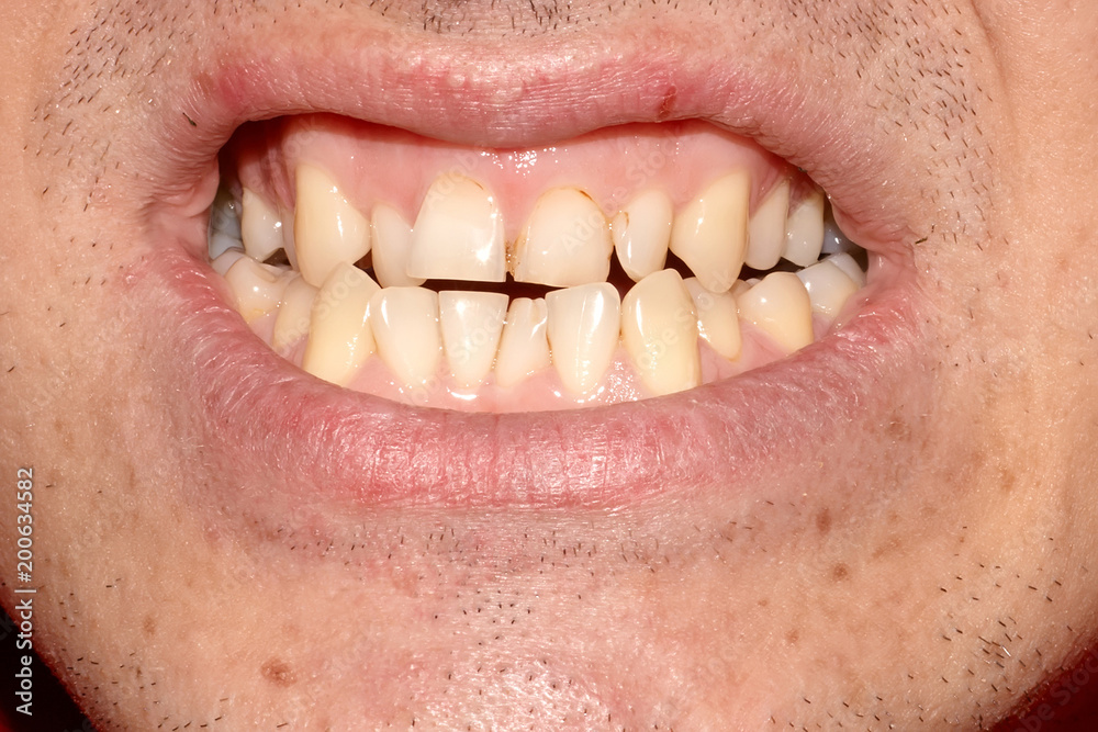 Mouth of man with crooked yellow overlap, crowding teeth close-up ...