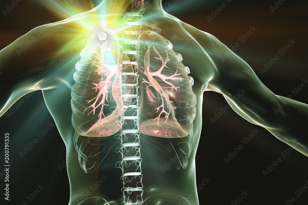 Tuberculosis treatment and prevention concept, 3D illustration showing ...