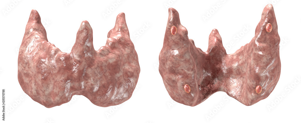 Thyroid gland, front and back view with parathyroid, realistic medical ...