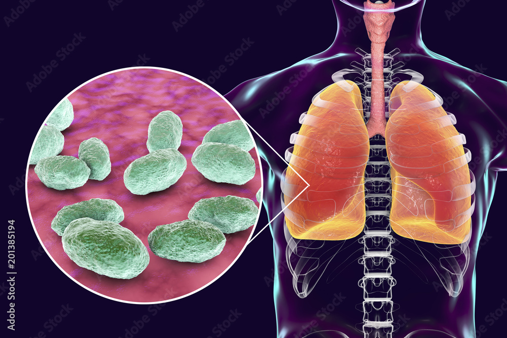 Pneumonia caused by Haemophilus influenzae bacteria, medical concept ...
