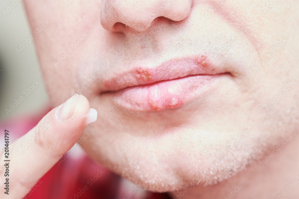 herpes simplex virus infection. Lips treatment by cream. Male face. Stock Photo | Adobe Stock