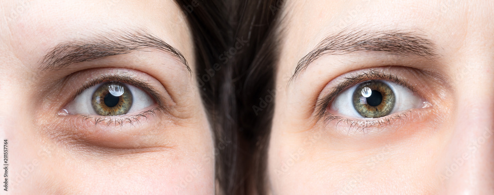 Swollen eye of woman before and after natural treatment to deflate them ...