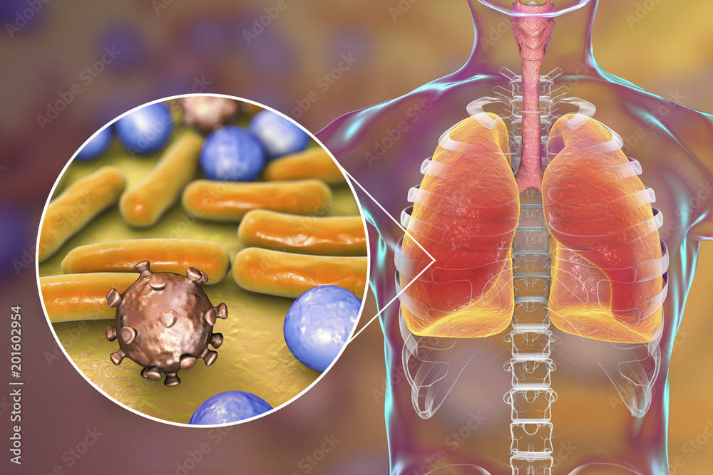 Pneumonia, medical concept, 3D illustration showing human lungs and ...