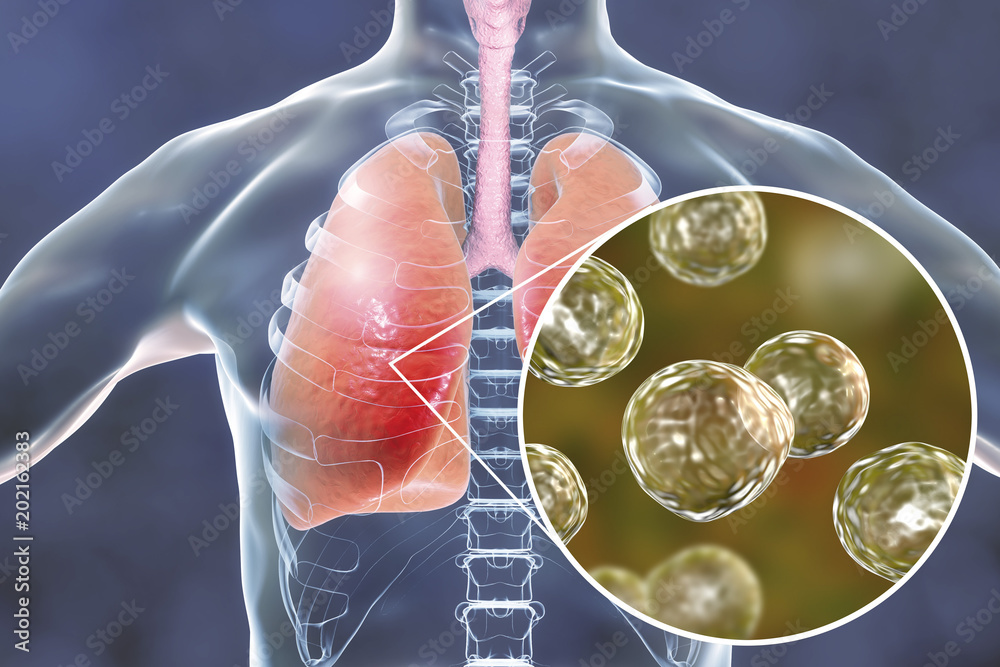 Blastomyces dermatitidis infection of lungs, conceptual image, 3D ...