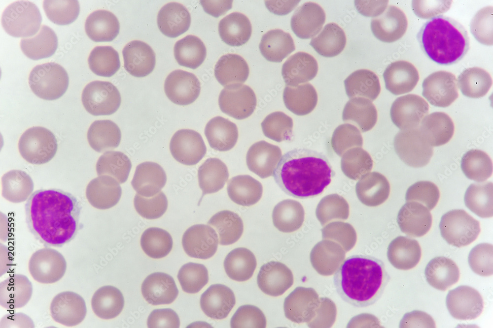Blood smear of chronic lymphocytic leukemia (CLL), analyze by ...