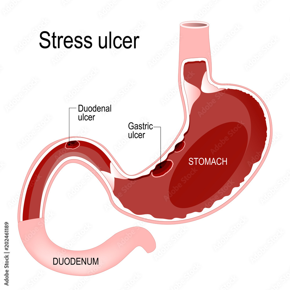 Poster Peptic ulcer disease – Quadro da Parete | Europosters