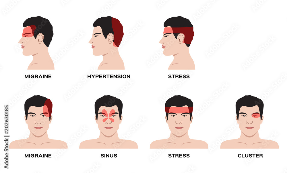 headache type vector / organ and anatomy concept Stock Vector | Adobe Stock