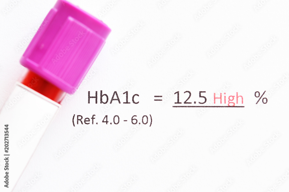 Abnormal high level HbA1c test result with blood sample Stock Photo ...