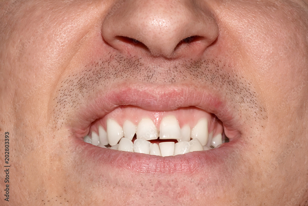 Close-up portrait of man with crooked white ugly teeth, terrible smile ...