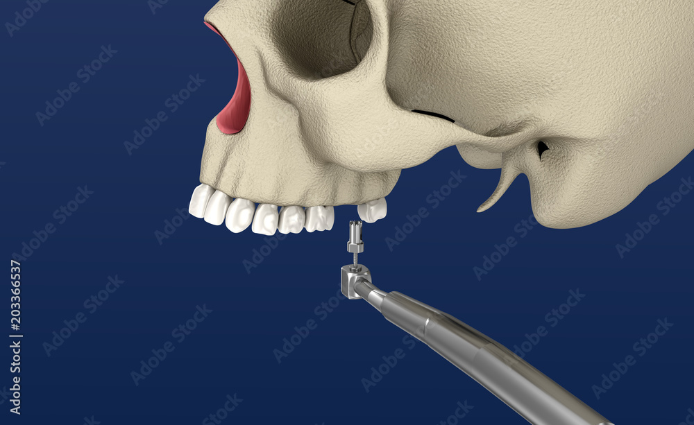 Sinus Lift Surgery - Sinus Augmentation. 3D illustration Stock ...