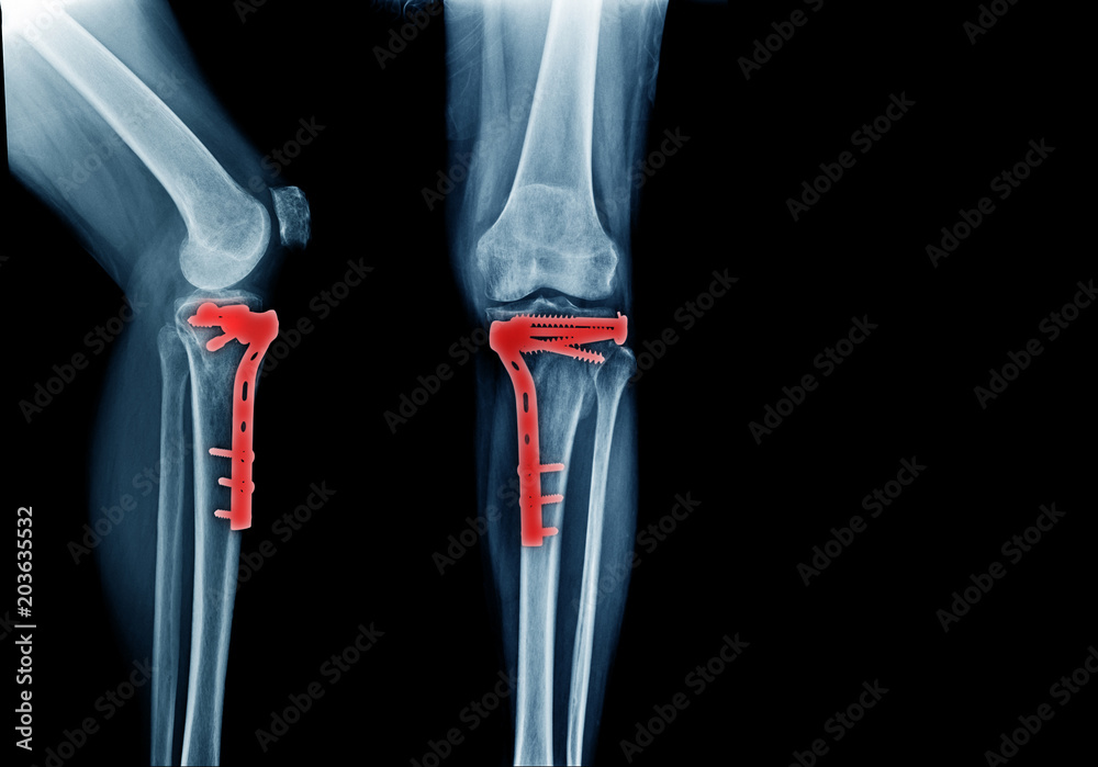 fracture tibia bone and post operation fixation anterior and lateral ...