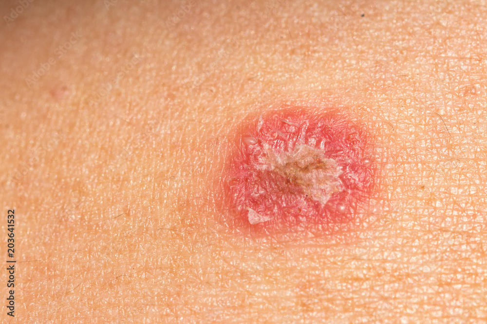 Ring Worm infection, Dermatophytosis on skin Stock Photo | Adobe Stock