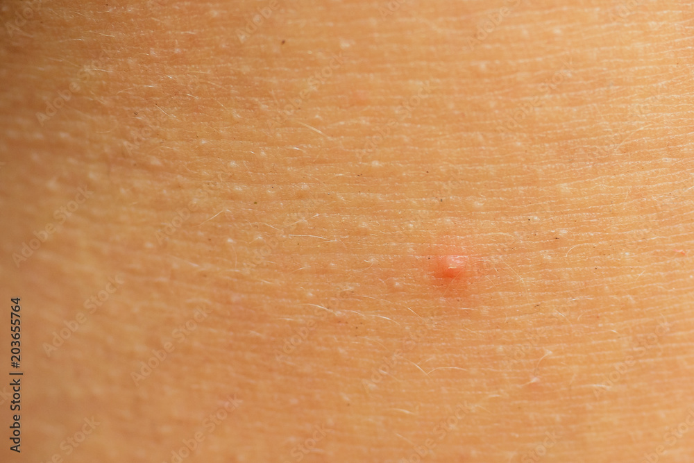 post-acne, scars and red festering pimples on the skin of the face ...