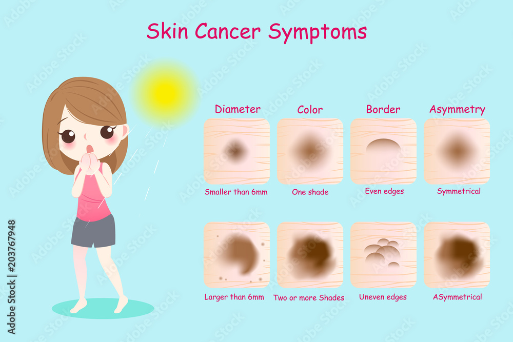 Poster woman with skin cancer symptoms – Wall Art | UkPosters