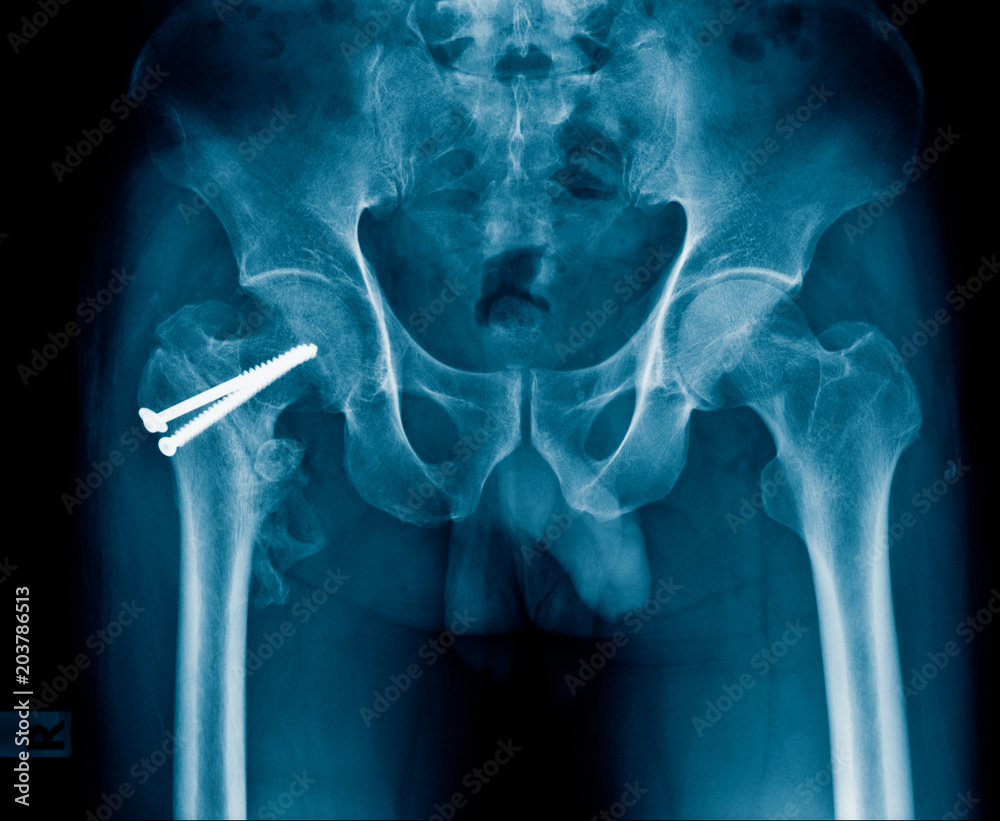 fixation hip by screw x-ray, image of x-ray hip fracture and post ...