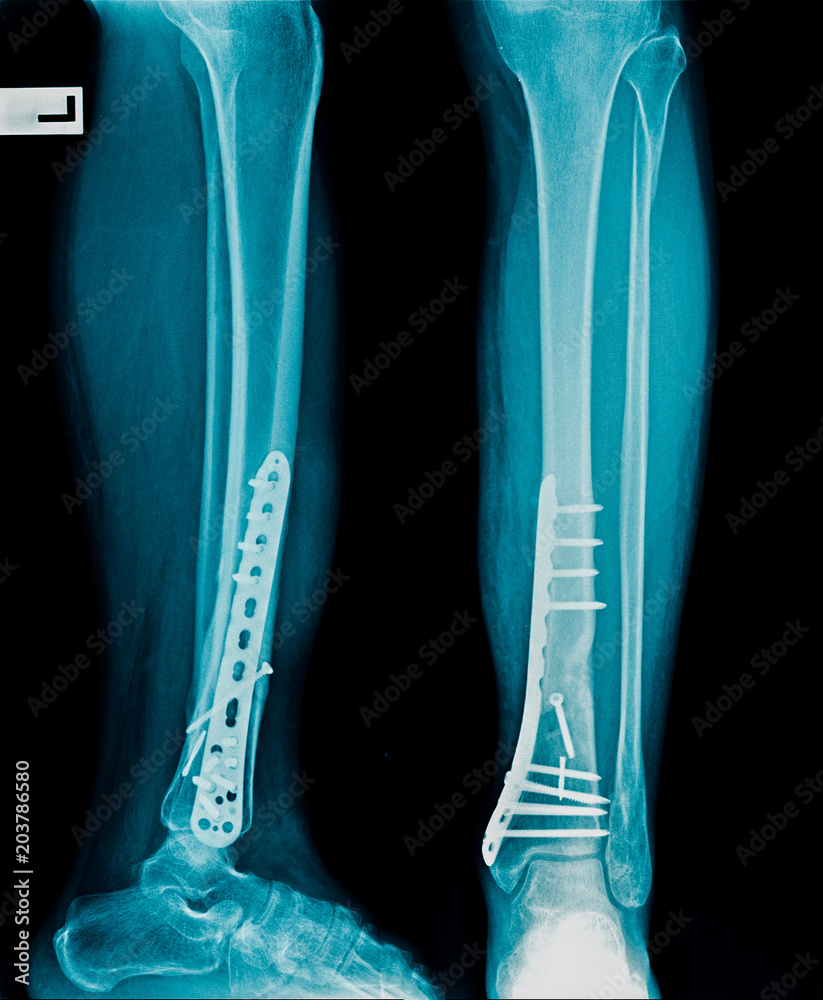 Distal Tibia Anatomy