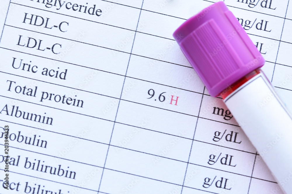 Blood sample with abnormal high uric acid test result Stock Photo ...