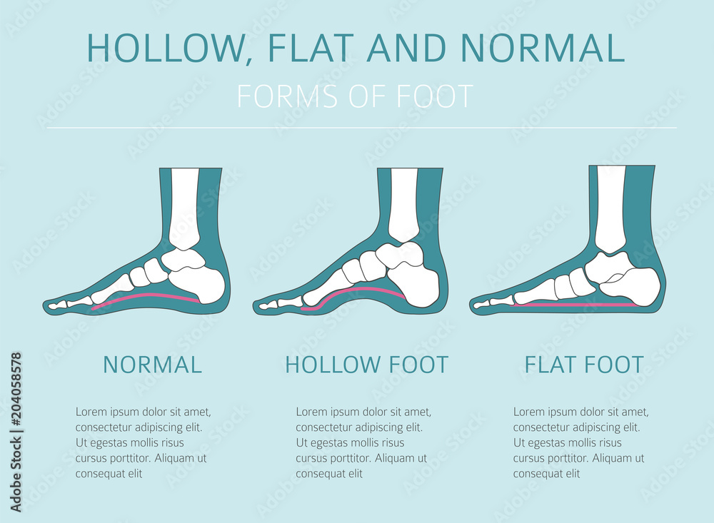Foot deformation types, medical desease infographic. Hollow, flat and ...