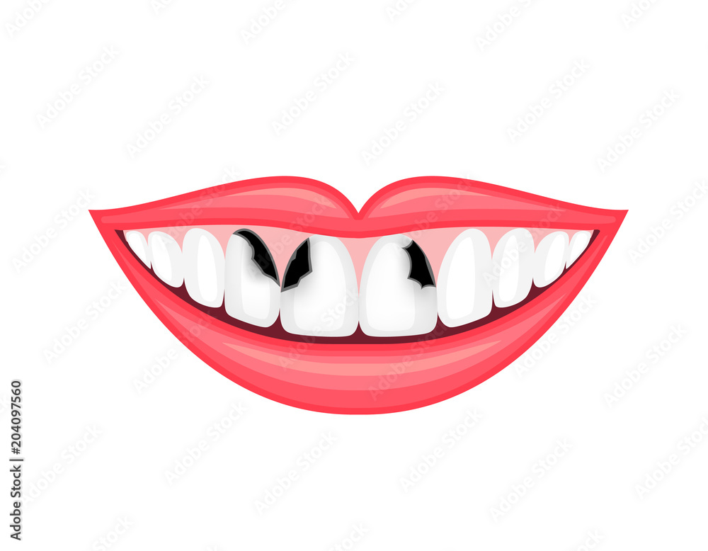 Tooth decay, unhealthy teeth. Human mouth, dental care concept ...