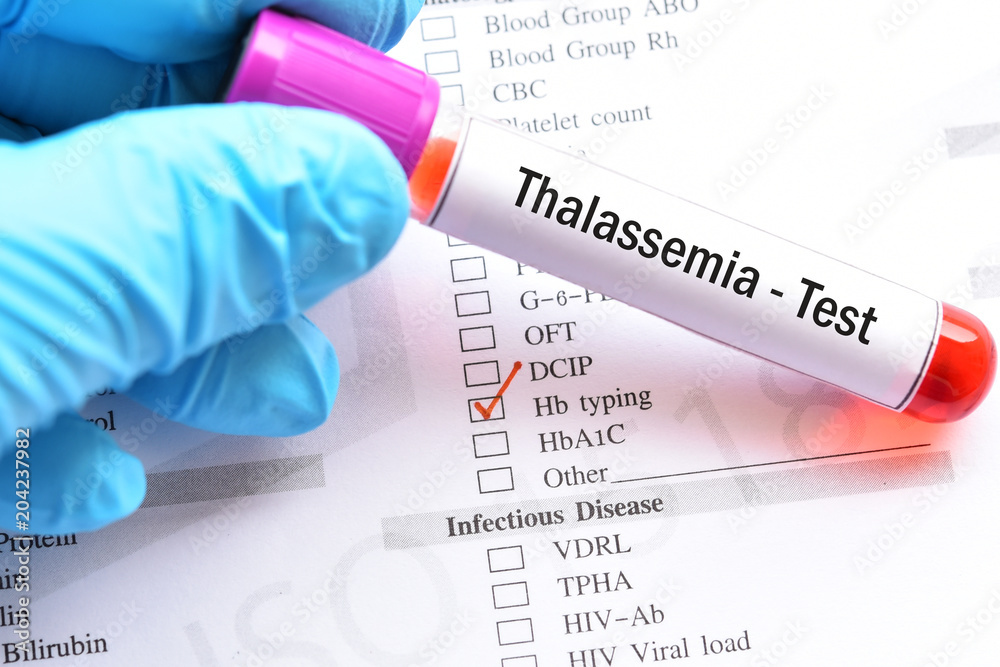Blood sample for thalassemia test Stock Photo | Adobe Stock