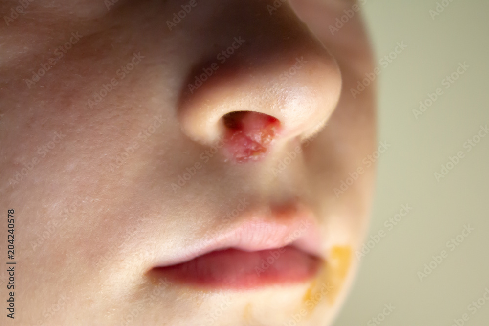 Herpes In Nose