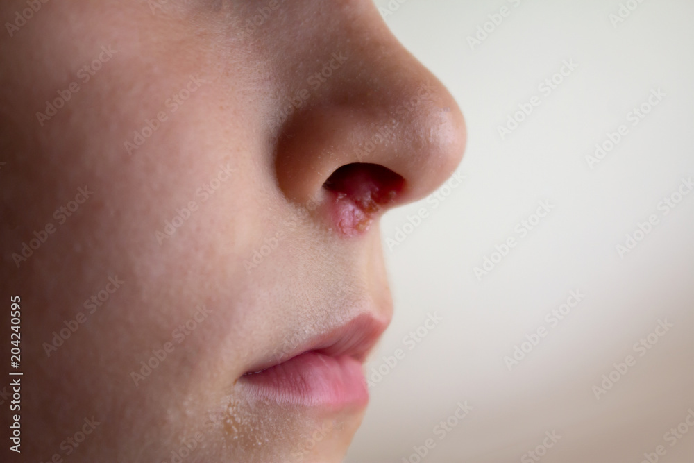 Herpes In Nose