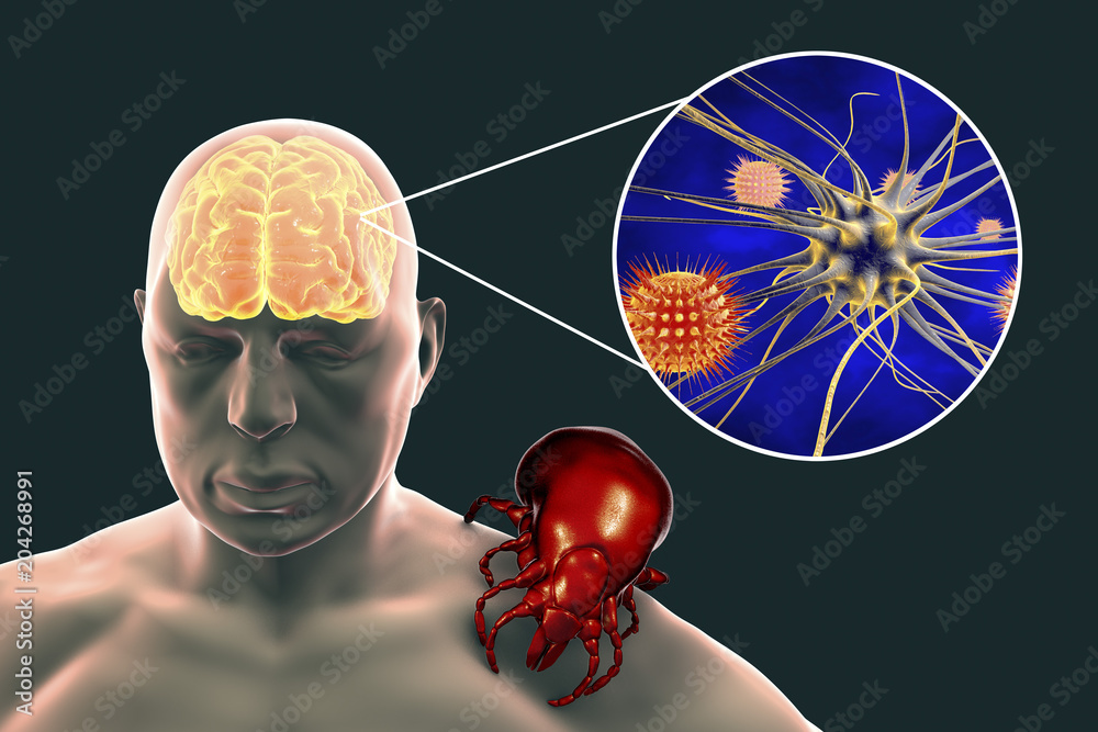 Tick-borne encephalitis concept, 3D illustration showing brain ...