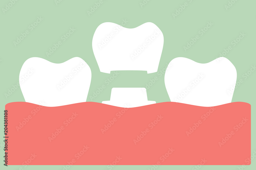 dental crown, installation process and change of teeth Stock Vector ...