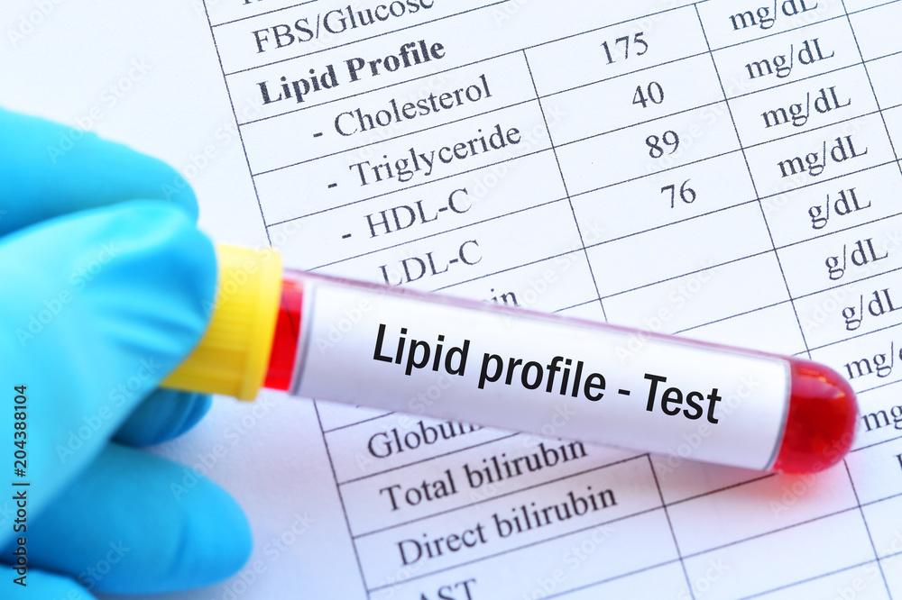 Blood sample with normal lipid profile result Stock Photo | Adobe Stock