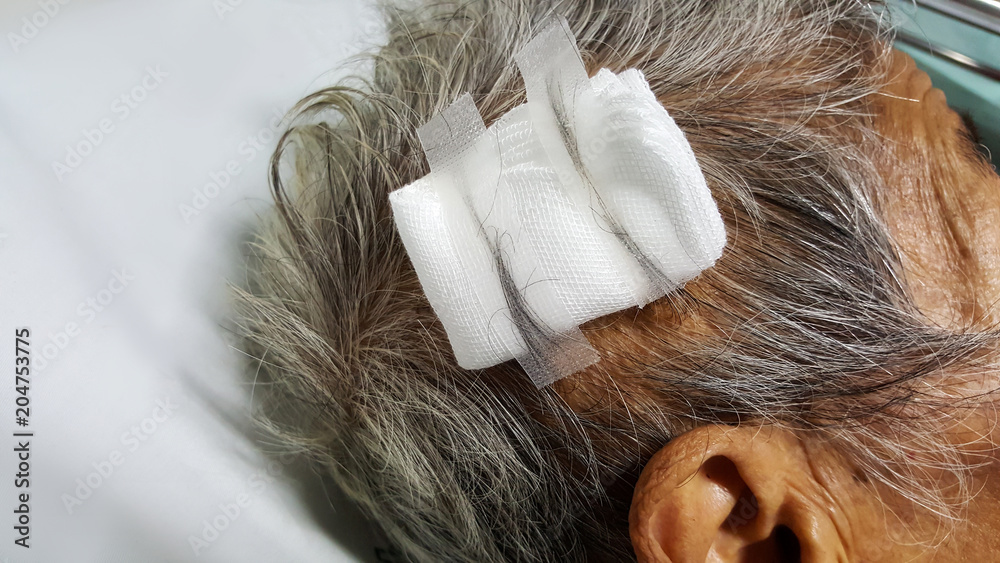 close-up old woman head injury, head trauma with stitch and gauze 스톡 사진 ...