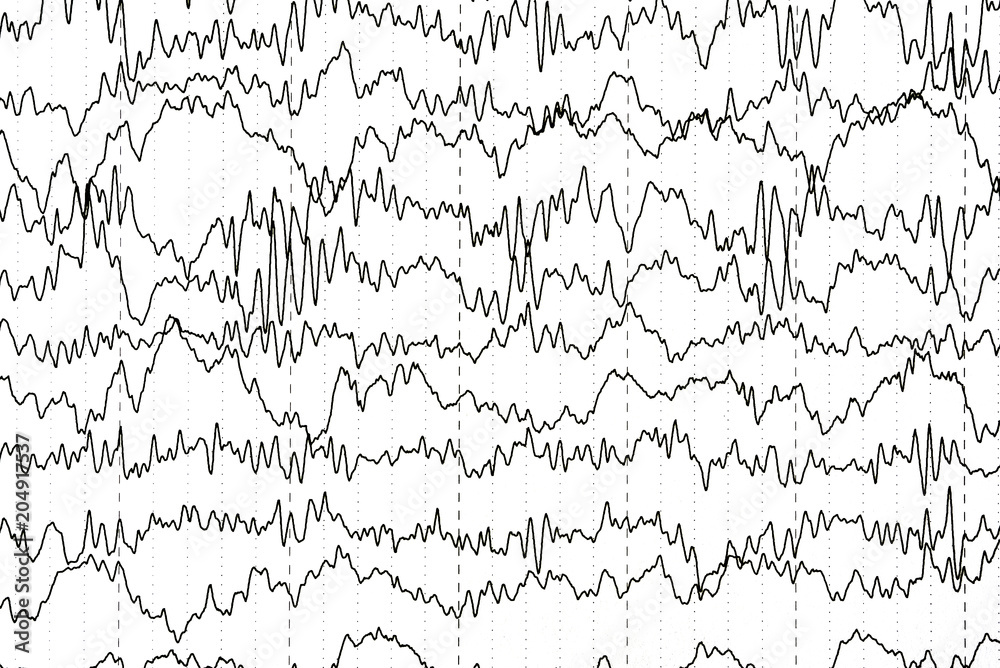 Abnormal Eeg