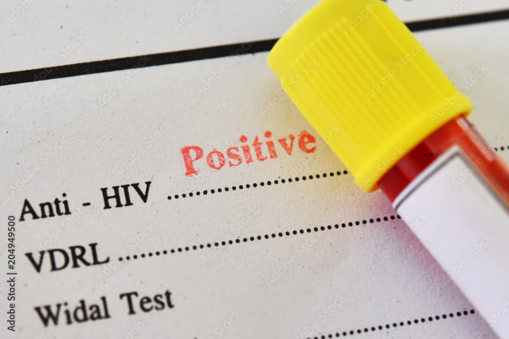 Hiv Positive Test Results