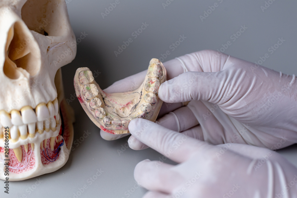 Study cast of Diagnostic cast and dental gypsum models in dental ...