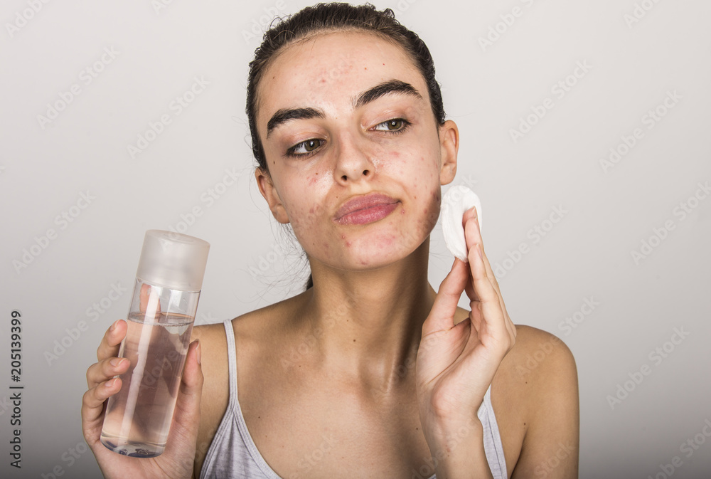 beautiful young girl with problematic skin, acne face and cleaning ...