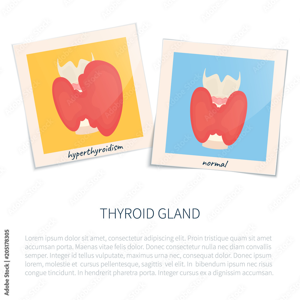 Hyperthyroid and healthy glands in photo frames. Thyroid diagram front ...