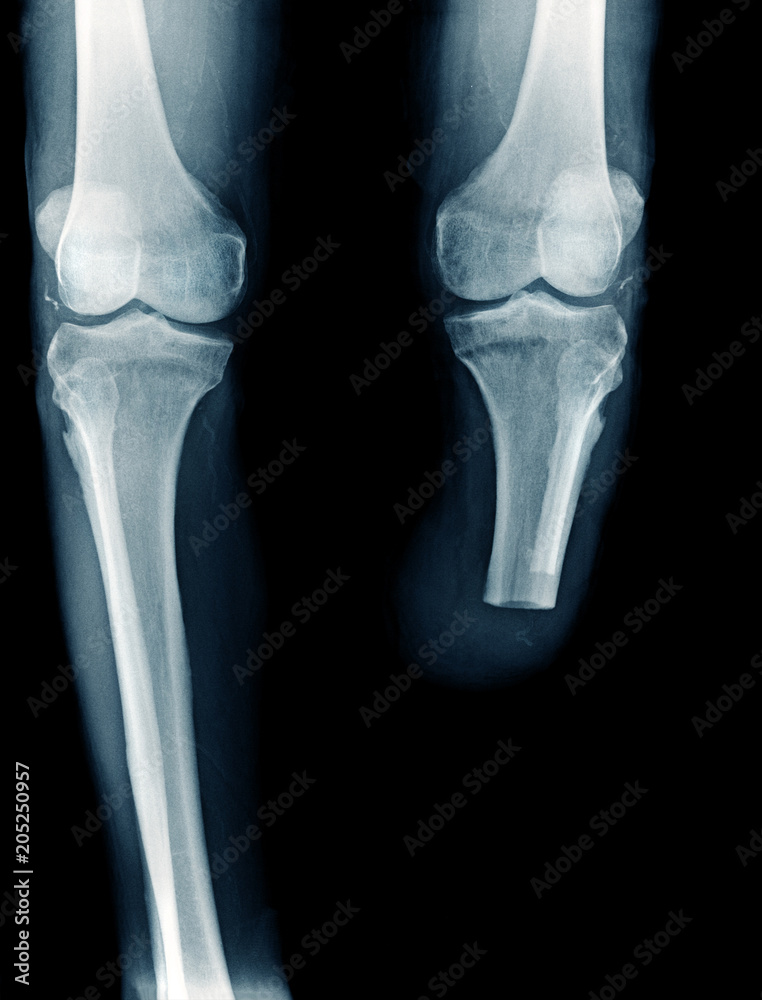 x-ray image below knee amputation or BKA amputation Stock Photo | Adobe ...
