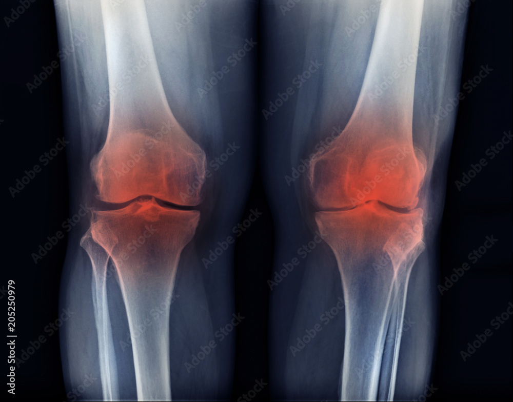 osteoarthritis knee x-ray image, high quality of OA knee PA view Stock ...