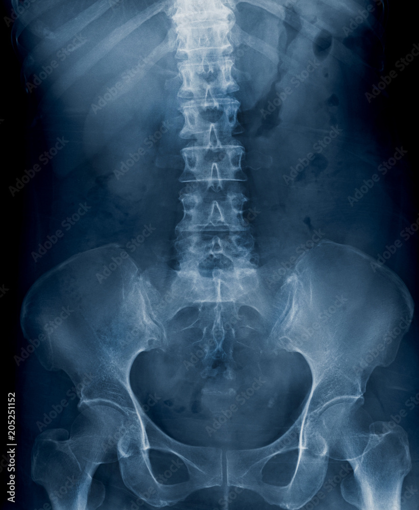 Spondylolysis X Ray