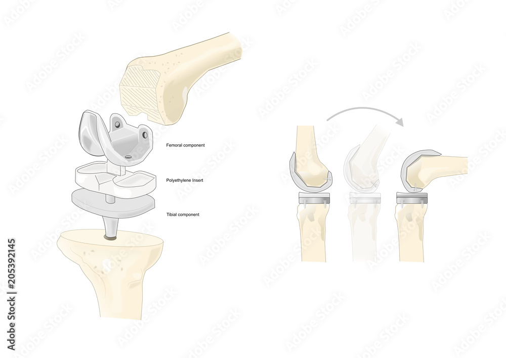 model of an artificial knee prosthesis and its parts Stock Illustration ...