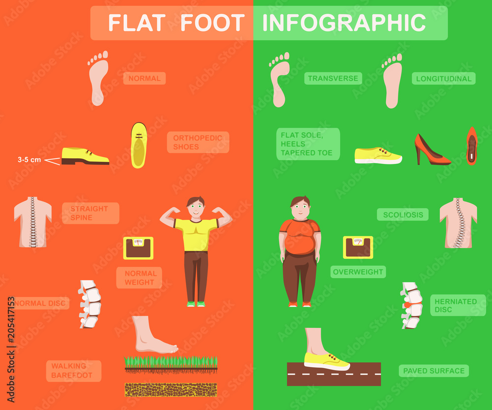 Flat foot and arch types infographic. Orthopedic disease, causes and ...