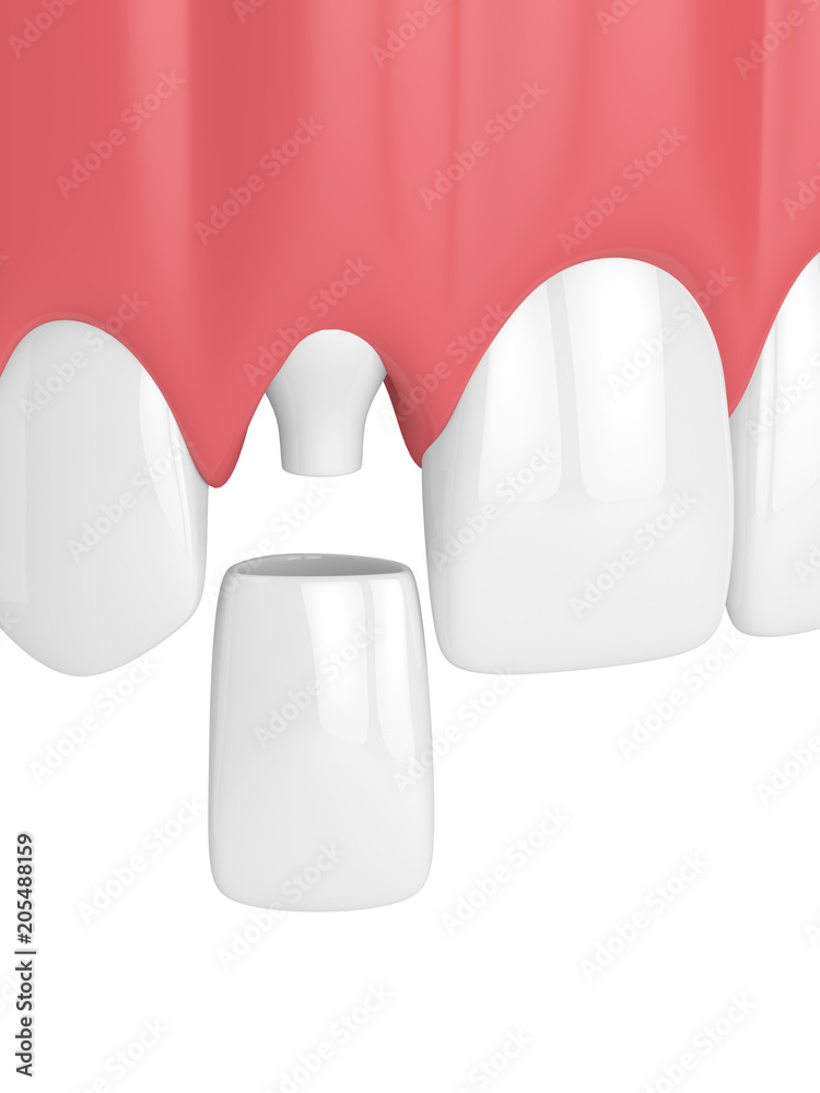 Poster 3d render of upper jaw with teeth and dental lateral incisor ...