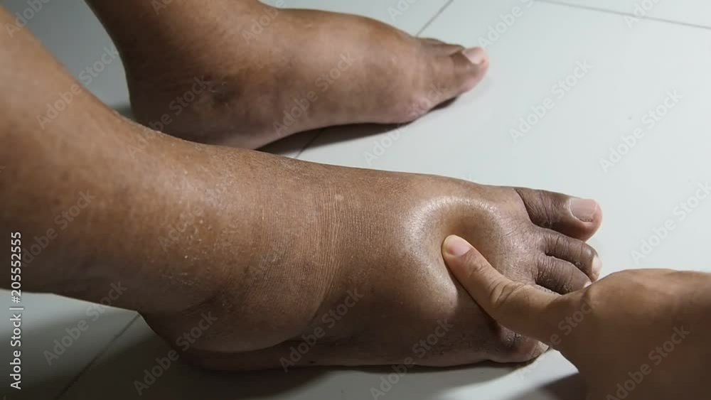 The feet of people with diabetes, dull and swollen. Due to the toxicity ...