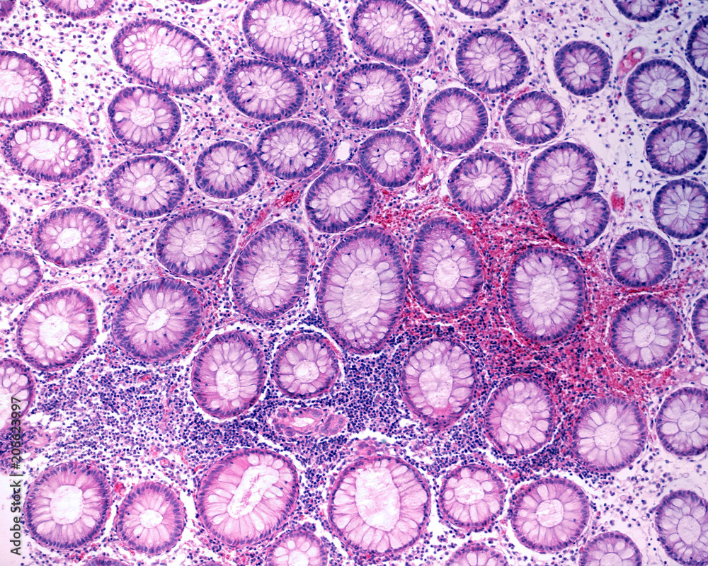 Colon. Chronic inflammation Stock Photo | Adobe Stock