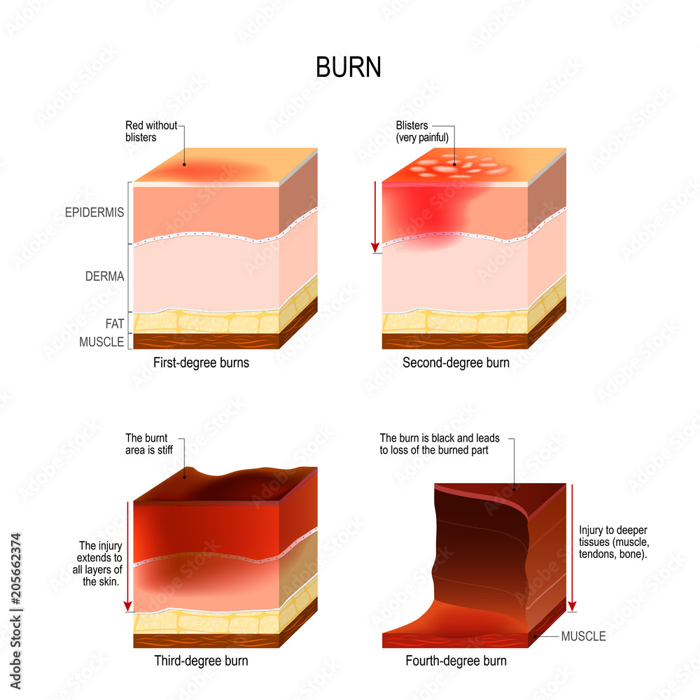 skin burn. four degrees of burns. Stock Vector | Adobe Stock