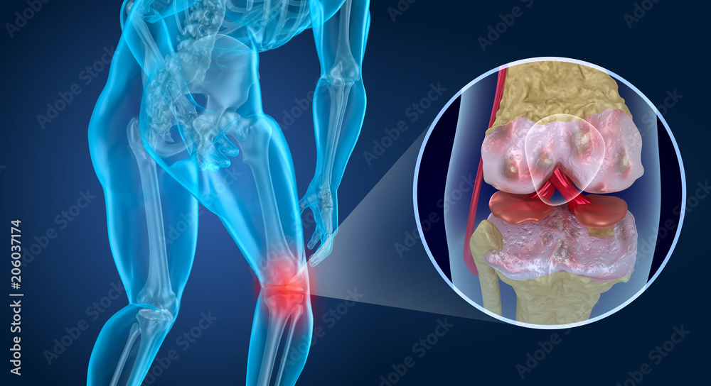 Knee pain Attack, man suffering from knee. 3D illustration Stock ...