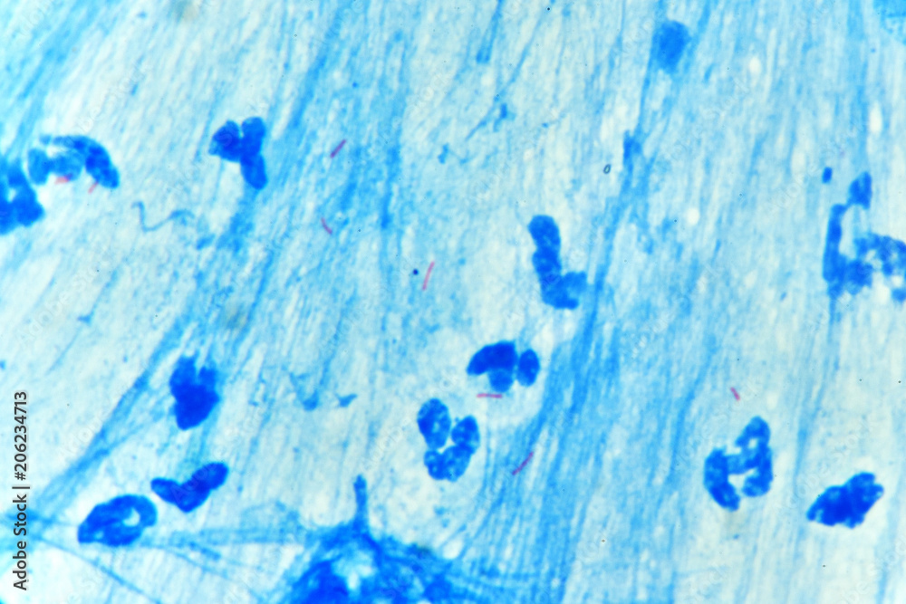 Mycobacterium Tuberculosis Acid Fast