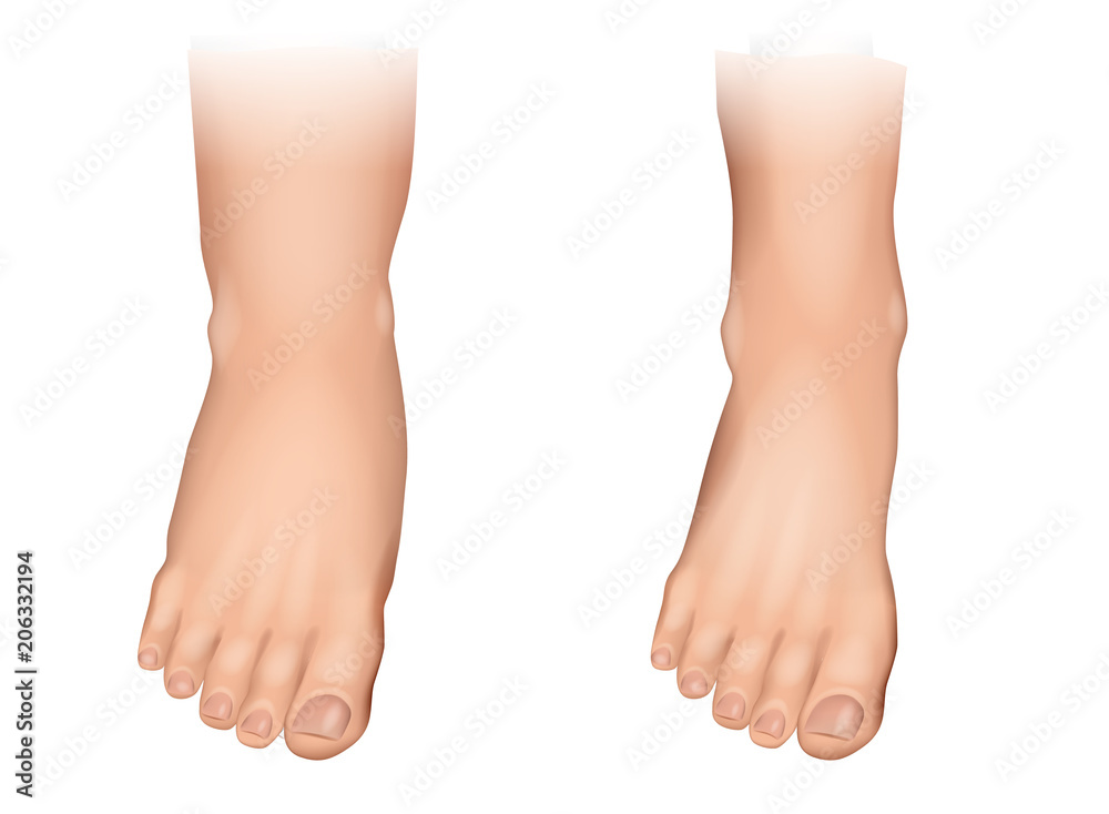 Vector illustration of edema on feet. Swelling of the feet and ankles ...