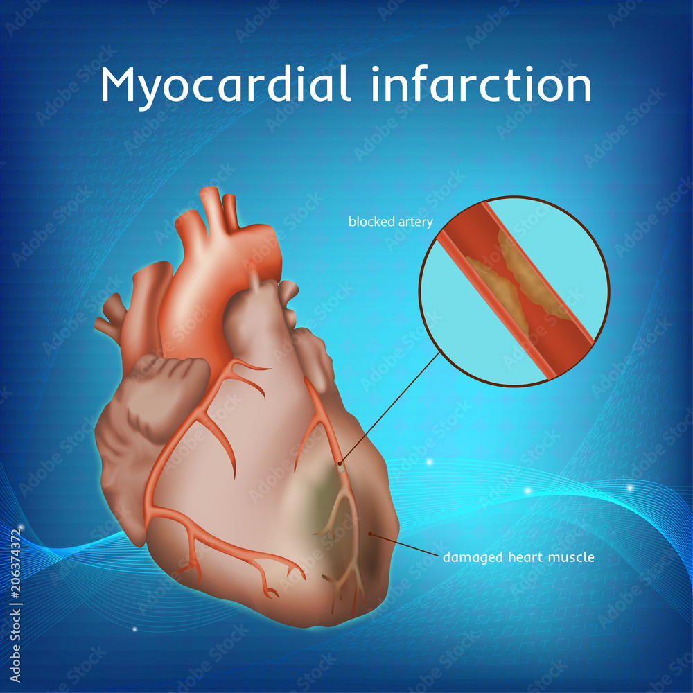 Myocardial infarction. Heart attack. Blocked artery, damaged heart ...