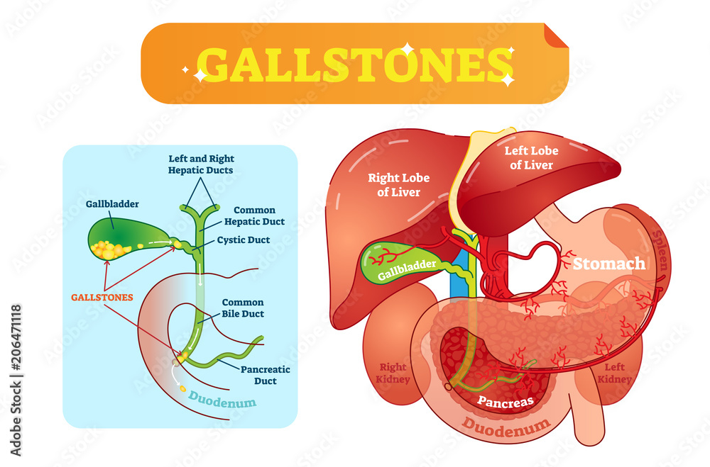 Plagát Gallstones anatomical cross section vector illustration diagram ...